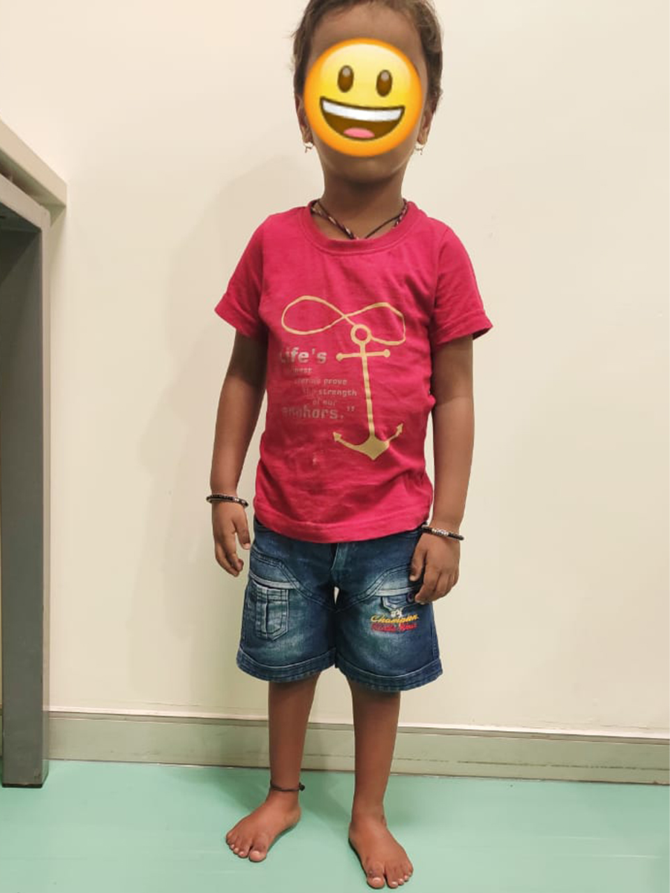 Club Foot Program – Annasawmy Hospital